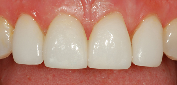 Porcelain Veneers | Atlanta GA › Killian Hill Dental Care - Lilburn, GA